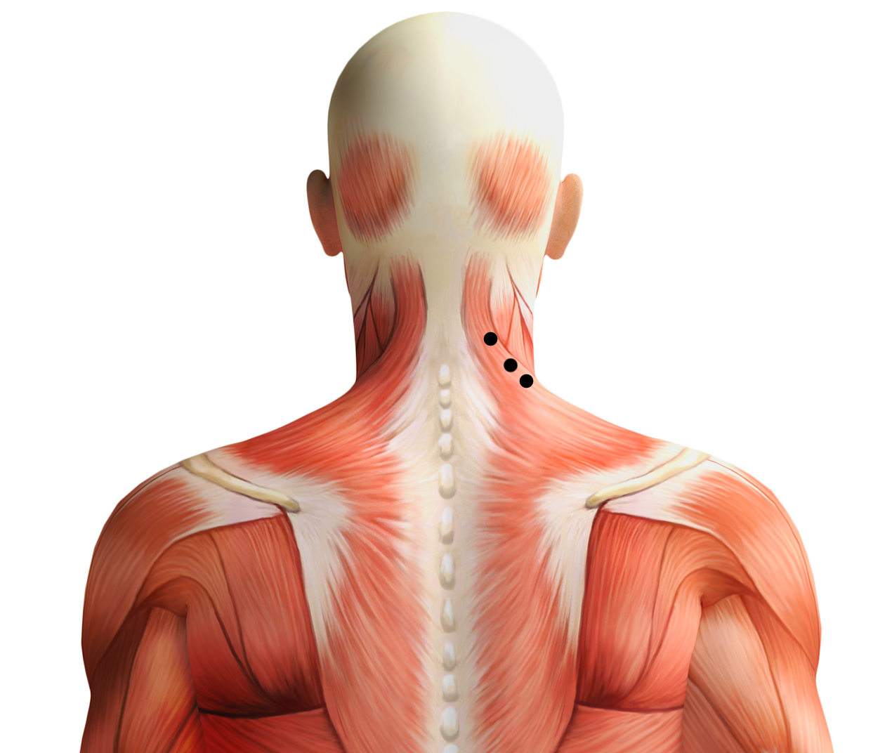 Trigger Point Übersicht – Triggerpunkte Übersicht Pdf – OPHL